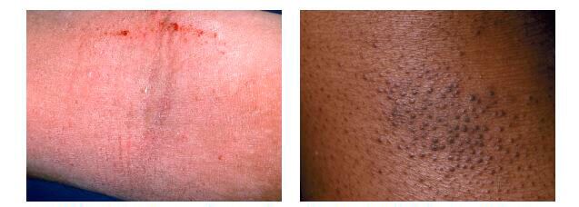 PELE NEGRA – Dr. Anderson